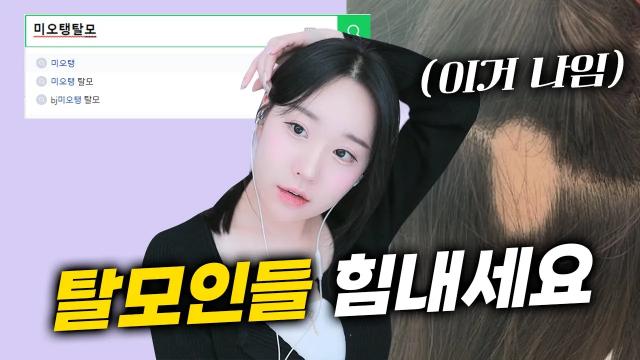 24살에 원형탈모.ssul | SOOP VOD